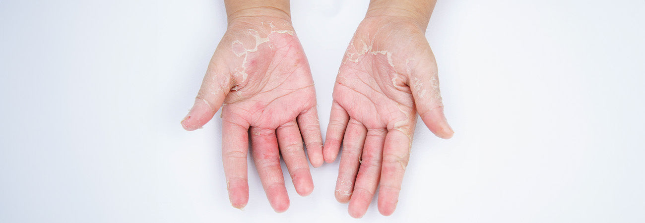 Psoriasis behandeling: welke opties zijn er voor jouw handen? - Herome ...